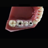 China Endosteal Dental Implants Bridges or Removable Dentures Lab China for sale