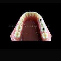 China Endosteal Dental Implants Bridges or Removable Dentures Lab China for sale