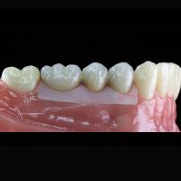 China Endosteal Dental Implants Bridges or Removable Dentures Lab China for sale
