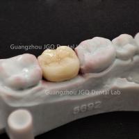 China Perfect Looking Beautiful Zirconia Ceramic Crowns with Gum Lifelike China Dental Lab for sale