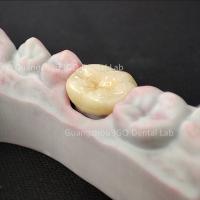 China Perfect Looking Beautiful Zirconia Ceramic Crowns with Gum Lifelike China Dental Lab for sale