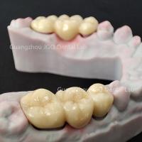 China Perfect Looking Beautiful Zirconia Ceramic Crowns with Gum Lifelike China Dental Lab for sale