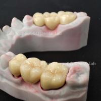 China Perfect Looking Beautiful Zirconia Ceramic Crowns with Gum Lifelike China Dental Lab for sale