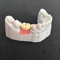 China Zirconia or Pfm Dental Implant Screw Retained Crown and Bridge for sale