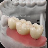 China Zirconia or Pfm Dental Implant Screw Retained Crown and Bridge for sale