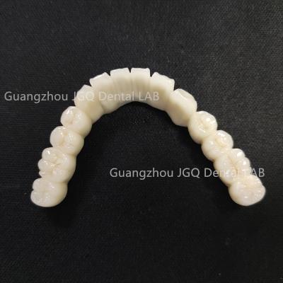 China Pfm Porcelain Fused To Metal Crown Cobalt Chrome Alloy Realistic Color Hard Texture for sale