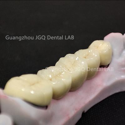 China Oral Restorations Pfm Teeth 3D Laser Printing Ultra Durable for sale