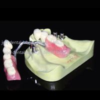 China Telescope Dental Crowns High Precision Milled Precision Attachments With Acrylic Teeth Set Up for sale