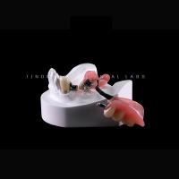 China Removable Denture Cobalt Chrome Precision Milled Attachments with Acrylic Teeth for sale