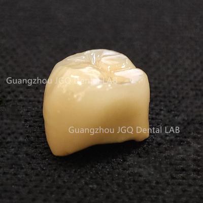 China Porcelain Metal Crowns Fixed Denture Restorations Metal Pfm Custom China Dental Lab for sale