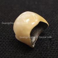 China Porcelain Metal Crowns Fixed Denture Restorations Metal Pfm Custom China Dental Lab for sale