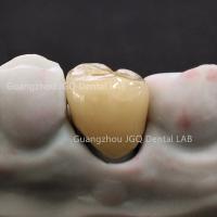 China PFM Porcelain Fused to Metal Dental Crown Natural Tooth Like for Oral Recovery for sale