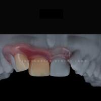 China Valplast Flexible Denture Invisible Base Similar Natural Gum Color Persistent Color Change for sale