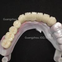 China Dental Pfm Crown and Bridge Restorations for Dental Care China Dental Laboratory for sale