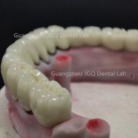 China Porcelain Fused To Metal Pfm Crown Dentures Co-Cr Alloy / Titanium Structure Aesthetic for sale