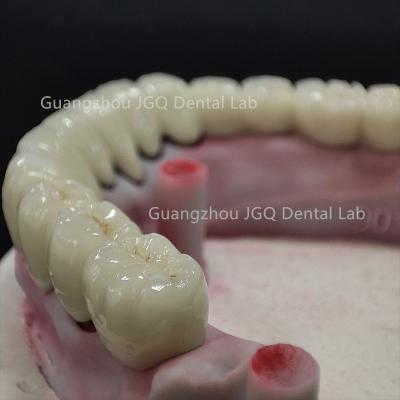 China Porcelain Fused To Metal Pfm Crown Dentures Co-Cr Alloy / Titanium Structure Aesthetic for sale
