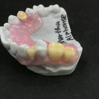 China Removable Flexible Denture Valplast Flexible Partial Dentures Prothesis China Dental Lab for sale