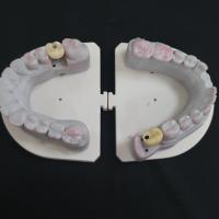 China Customized Dental Implant Guides and Dentures 3D Laser Printing CE FDA Certified for sale