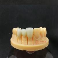 China Denture False Teeth PFZ Crowns Bridges Chinese Dental Lab Customized for sale