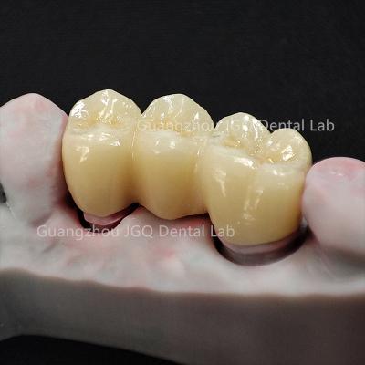 China Implant Teeth Zirconia Ceramic Crown Dental Bridge 3D Laser Printing Customized for sale
