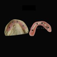 China Permanent Restoration Full Contour Zirconia Crown Dental Implant with Custom Milled Titanium Frame for sale