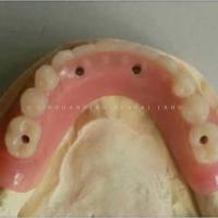 China Permanent Restoration Full Contour Zirconia Crown Dental Implant with Custom Milled Titanium Frame for sale