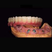 China Monolithic Zirconia Crown Full Jaw Implant Bridge Cement Retained Implant Crown and Bridge for sale