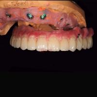 China Monolithic Zirconia Crown Full Jaw Implant Bridge Cement Retained Implant Crown and Bridge for sale