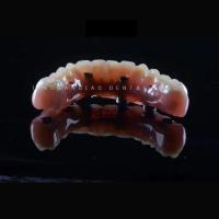 China Multi Unit Abutment Titanium Alloy Zirconia Bridge Dental Implant Durable Prosthesis for sale