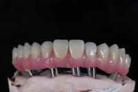 China Multi Unit Abutment Titanium Alloy Zirconia Bridge Dental Implant Durable Prosthesis for sale