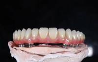 China Multi Unit Abutment Titanium Alloy Zirconia Bridge Dental Implant Durable Prosthesis for sale
