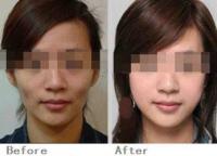 China High Molecular Hyaluronic Acid Anti Aging Cosmetic Dermal Filler For Face Injection for sale