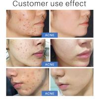 China 72 Pcs Hydrocolloid Acne Patch Waterproof Pimple Absorbing Cover Spot Treatment for sale