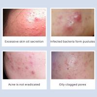 China 72 Pcs Hydrocolloid Acne Patch Waterproof Pimple Absorbing Cover Spot Treatment for sale