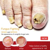 China GMP Nail Repair Pen for Damaged Fungal Infection Anti Fungal Treatment 10ml for sale