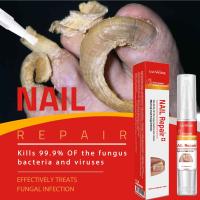 China GMP Nail Repair Pen for Damaged Fungal Infection Anti Fungal Treatment 10ml for sale