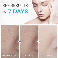 China Herbal 30g Skin Care Face Cream Dark Spot Corrector Remover for sale