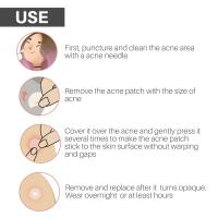 China Hydrocolloid Acne Pimple Patch Waterproof Treatment Acne Patches for sale