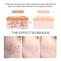 China Acne Scar Removal Face Cream with Salicylic Acid 50g Anti Acne Treatment Whitening Cream for sale
