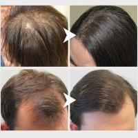 China Hair Growth Spray 1.01oz Prevent Hair Loss Promote Scalp Health Anti Bald Treatment for sale