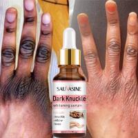 China Dark Knuckle Whitening Serum 30ml Knees Elbows Glow Fade Dark Spots Skin Care for sale