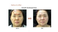 China Focused Ultrasound Beauty Salon Machine 2MHz RF For Skin Lifting for sale