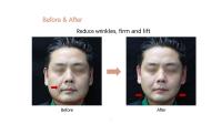 China Focused Ultrasound Beauty Salon Machine 2MHz RF For Skin Lifting for sale