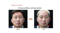 China Focused Ultrasound Beauty Salon Machine 2MHz RF For Skin Lifting for sale