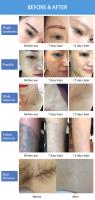 China Microblading Diode Professional Laser Machine Hair Removal Painless for sale