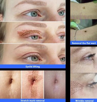 China Korea Fibroblast Plasma Pen Jet Plasmalift for Face Eyelid Lift Premium 100W for sale