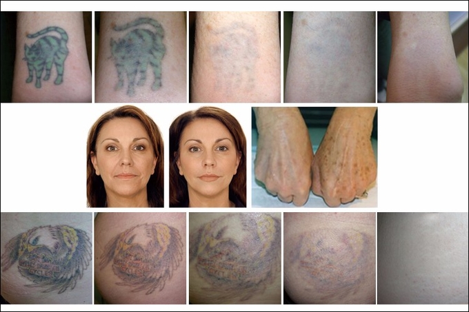 Picosecond Laser Tattoo Removal Machine AC 220V For Cleaning Skin Rejuvenation 0