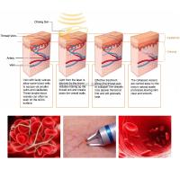 China Home Use Tattoo Laser Removal Machine Fungal Remover Onychomycosis Cure for sale