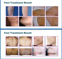 China 808 Diode Laser Tattoo Removal Machine 110V ND YAG for sale
