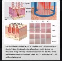 China Vaginal Stationary Fractional CO2 Laser Machine Skin Resurfacing Equipment for sale